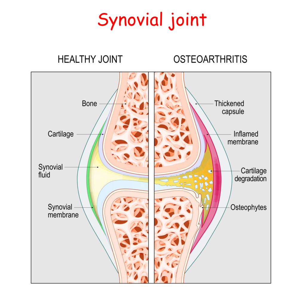 Osteoarthritis Doctor in Oviedo, FL | Explore Treatments