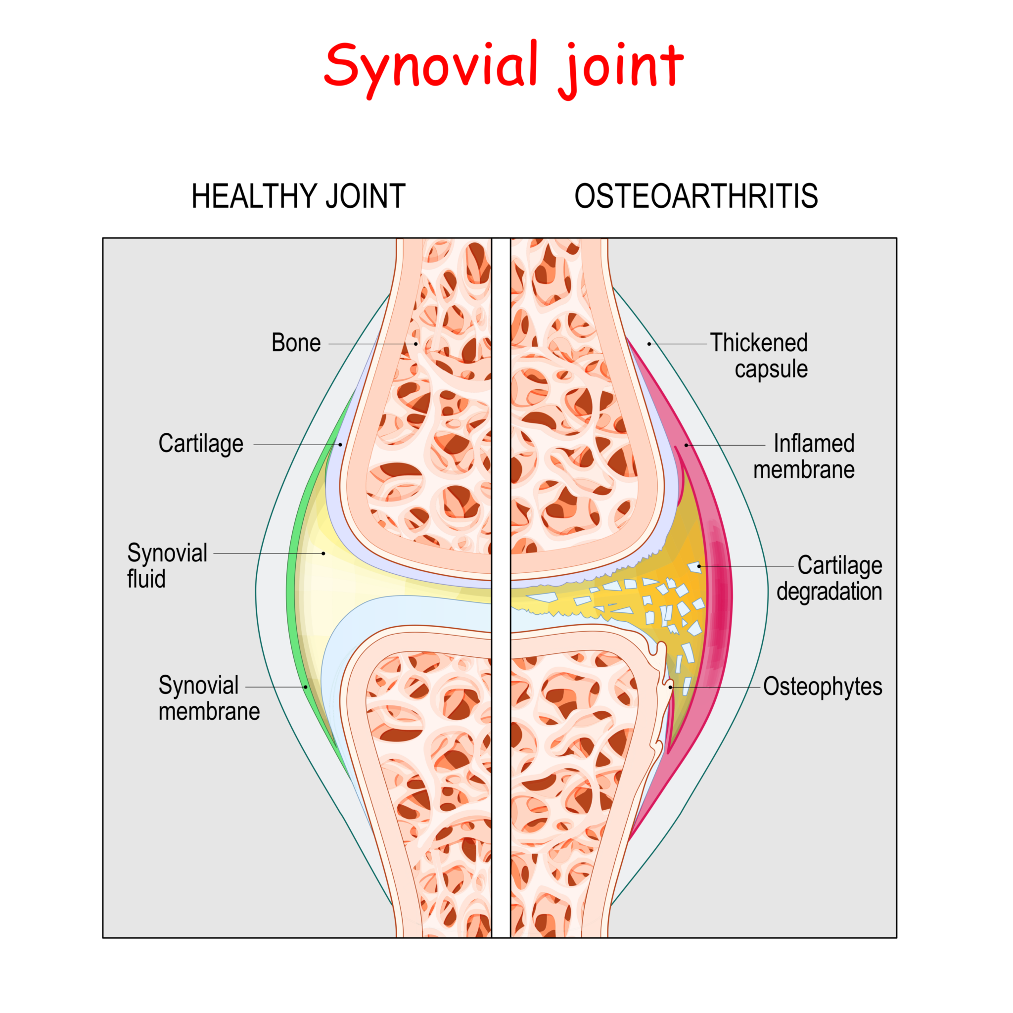 Osteoarthritis Doctor in Oviedo, FL | Explore Treatments
